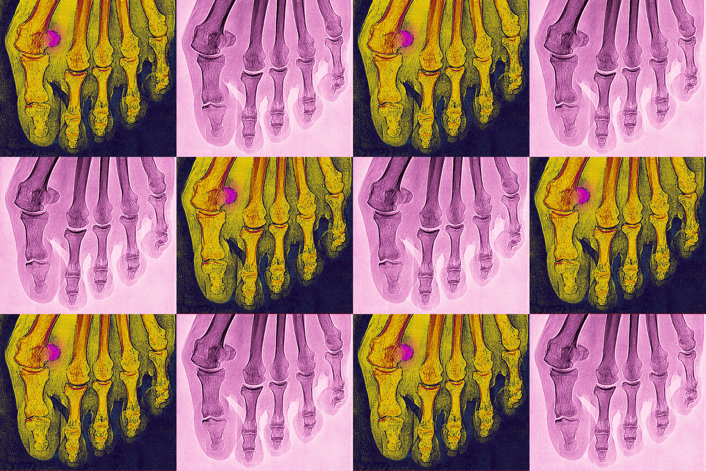 What to Do About Your Bunions