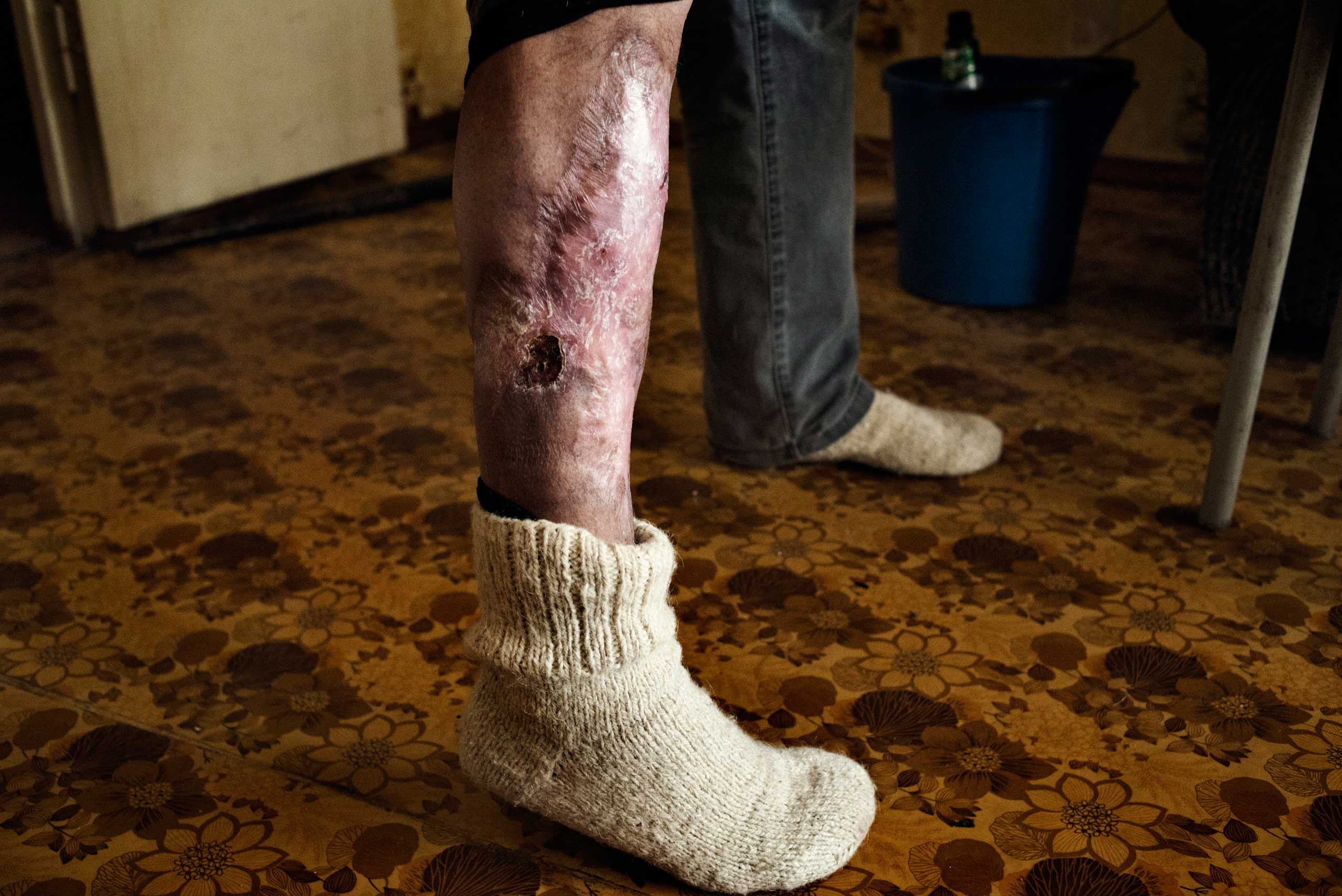 The World’s Deadliest Drug: Inside a Krokodil Cookhouse