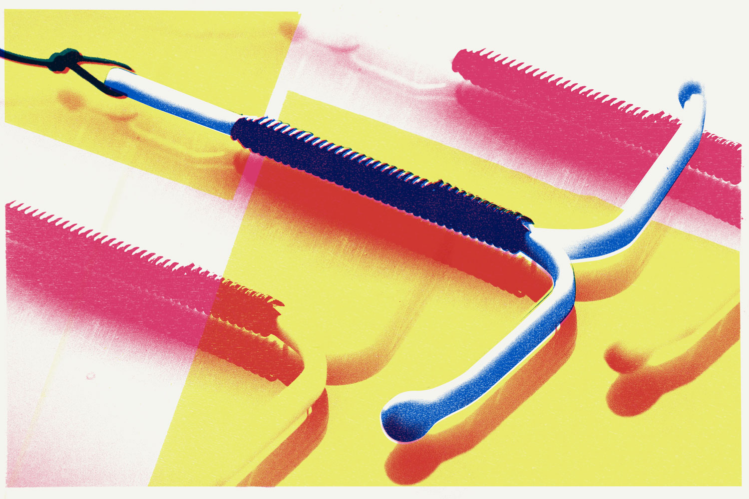 IUD Birth Control: Everything You Need to Know